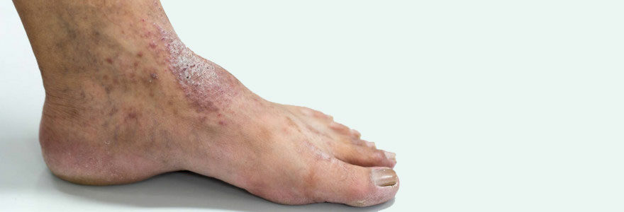 Tout savoir sur le psoriasis palmo-plantaire.